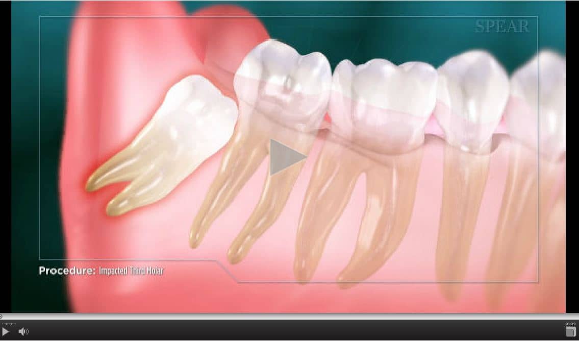 Videos - Nebo Dental Centre | Dentist In Hamilton